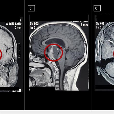 Preoperative Contrast Enhanced Mri A Preoperative Contrast Enhanced