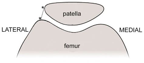 Schematic Diagram Of The Patellofemoral Articulation In Axial Section