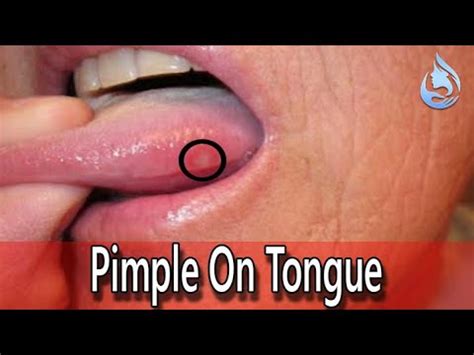 Pimple On Tongue Can Be Treated With These 5 Simple And Effective Home