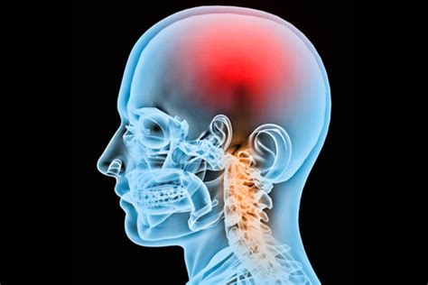 Contusiones Cerebrales Definicion Rqrr