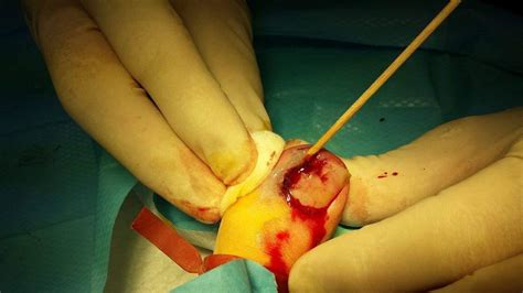 Toe Procedure Scrolller