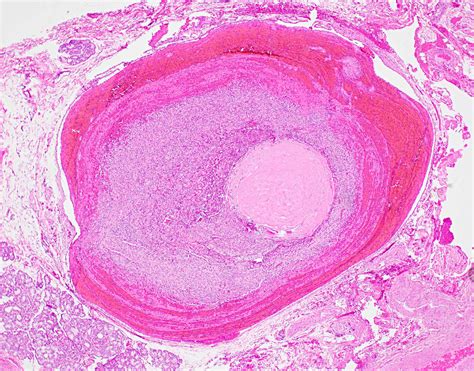 Pathology Outlines Varix Varicosities Varices