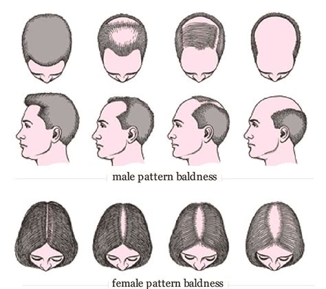 Baldness Archives Wellness Guide Baldness Archives Wellness Guide