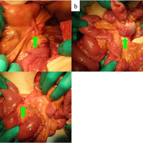 A Gross Appearance Of The Largest Mesenteric Desmoid Tumor That Was Download Scientific