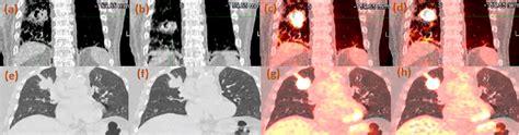 Images From Patients 2 And 3 Were Illustrated In The Upper And Lower