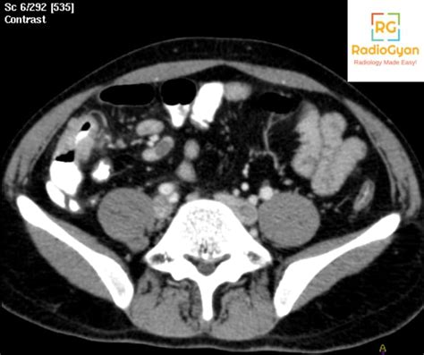 Ileocecal Tuberculosis Radiology Case Radiogyan