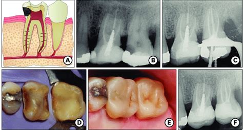 Scenario 3 A Diagram Juxta Gingival Decay That Reaches The Pulp