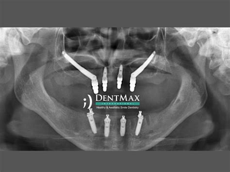 All On 4 With Zygoma Implants Full Jaw Restoration Dentmax Istanbul