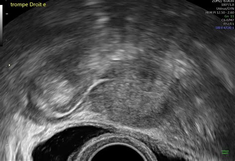 Nouveauté à Lirh Hyfosy Institut Rhonalpin Reproduction Humaine à Lyon