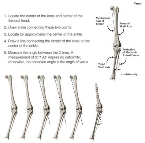 Measurement Of Deformity Download Scientific Diagram