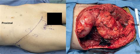 Right External Hemipelvectomy And Hemisacrectomy Resulted In A 45 Â 20