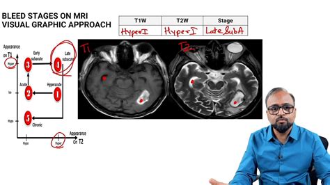 Mri Intracranial Bleed Stages Edition 8 Sample Video Radiology Youtube