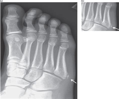 Journal Of Pediatric Orthopaedics B