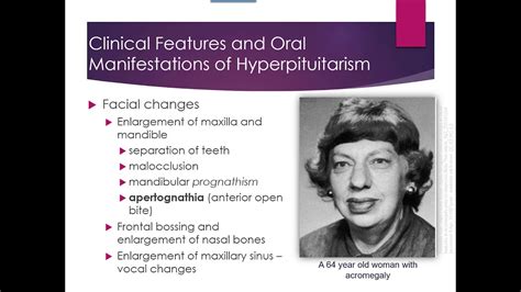 Chapter 9 Part 2 Hyperpituitarism Youtube