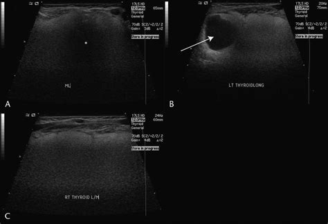 Diffuse Lipomatosis Of The Thyroid Gland Ultrasound Quarterly