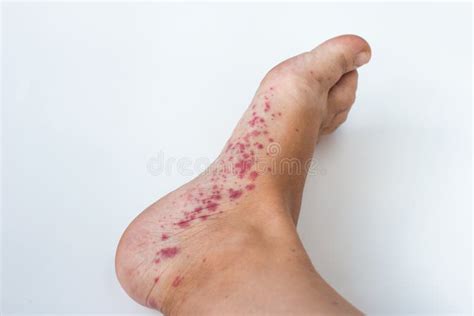 Herpes Zoster Pictures On Legs