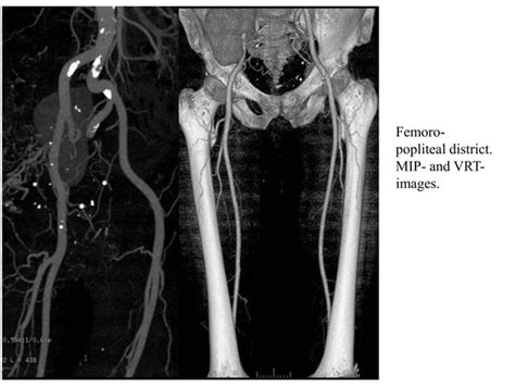 Ct Angiography Lower Limb Pptx