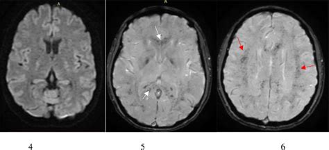 4 Axial Dwi Sequence Appears Normal No Areas Of Restriction Were Download Scientific