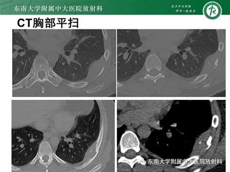 【病例】肋骨孤立性溶骨性病变病例讨论 影像ppt