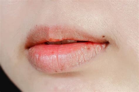 Causes And Solutions Of Dry And Chapped Lips Su Skin