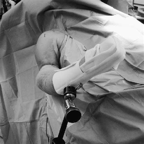 4 A Blunt Tipped Elevator Or Small Bone Tamp Is Placed Through The Download Scientific Diagram