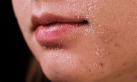 Allergische Reactie Na Een Chemische Peeling Alhydran