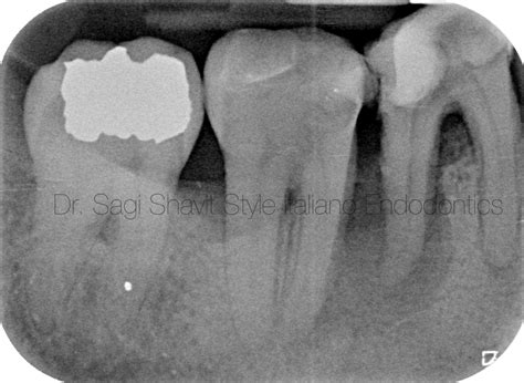 Poor Prognosis Style Italiano Endodontics