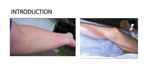 Lymphangitis And Lymphoedemapptx