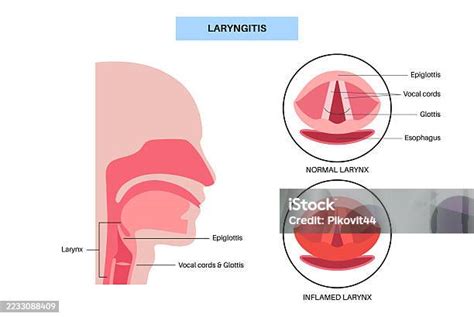 Laryngitis Medical Poster Stock Illustration Download Image Now