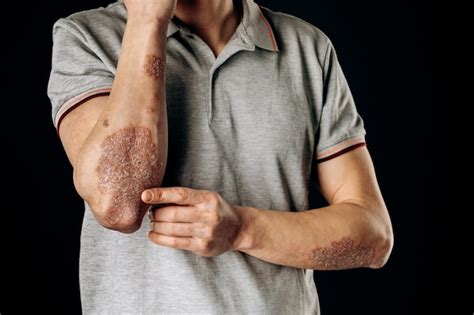 Psoriasis Elbow