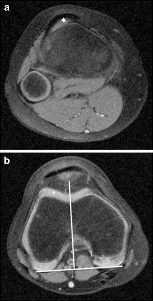 Tibial Tuberosity Trochlear Groove Distance Measured In A 6 Year Old
