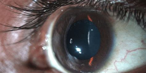 Keratoconus Diagnosis Screening And Treatment Neoretina