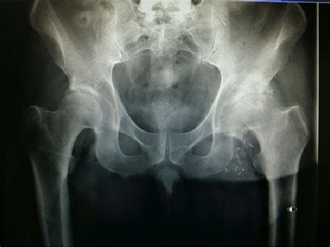 Pre Operative Ap Pelvis Radiograph Download Scientific Diagram