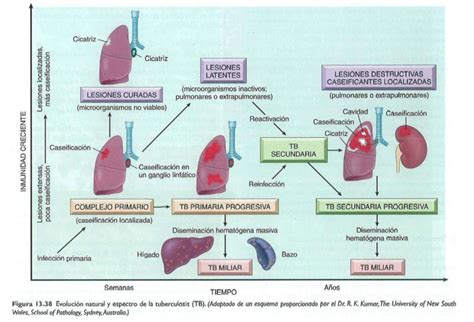 Tuberculosis Diagram Quizlet