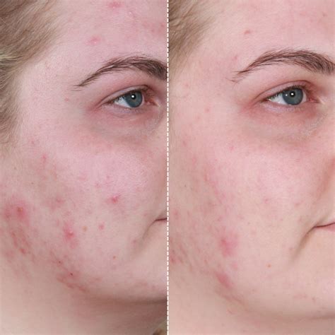 Microcurrent Acne Treatment Device Ziip Dot