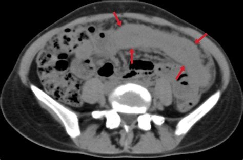Intra Abdominal Tuberculosis Pacs