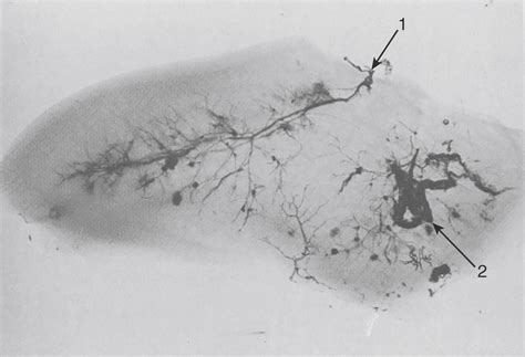 Scaphoid Fractures Clinical Tree