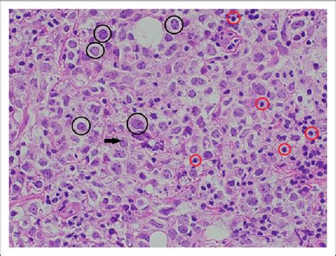 There Are Large Pleomorphic Lymphocytes Black Circles Admixed With