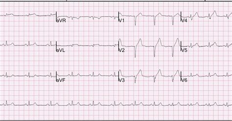 Dr Smiths Ecg Blog Subtle St Elevation In Acute Lad Occlusion Persistent St Elevation Due To
