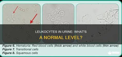 Leukocytes In Urine Whats A Normal Level Medshun