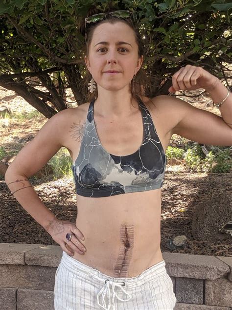 Ariels Stage 4 High Grade Appendix Cancer Story The Patient Story For Cancer Patients