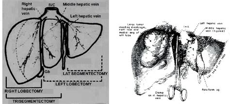 Figure 1 From Experiences Of 30 Years In Right Trisectionectomy For Huge Liver Tumor Semantic