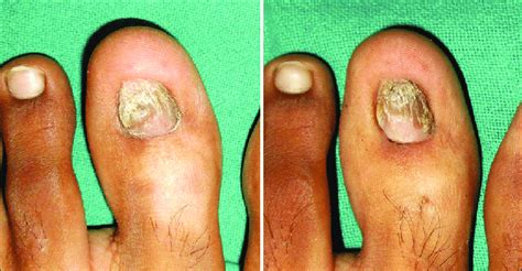 A Hypopigmentation And Atrophy Involving The Proximal Nail Fold Seen