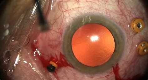 Red Reflex Cataract