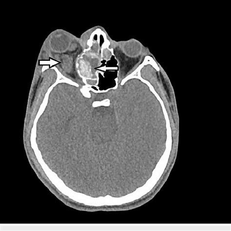 Initial Ct Orbit Showing Sinusitis With Orbital Cellulitis And Small Download Scientific