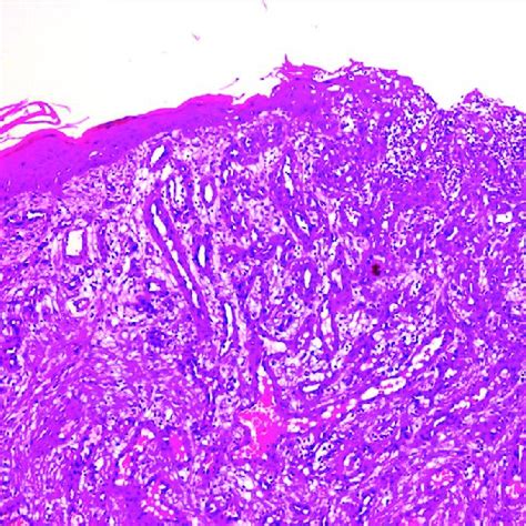 Epithelial Morphology Showing Atrophic To Ulceration Seen Predominantly