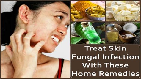 Fungal Infection Treatment When Pregnant At Christiana Shepherd Blog