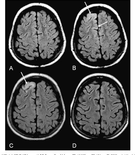 Figure 1 From Anti Nmda Receptor Encephalitis Presenting With Imaging Findings And Clinical