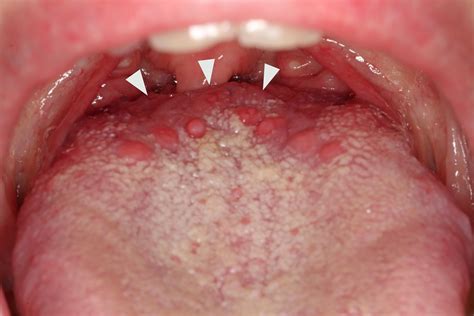 Tonsillar Hypertrophy