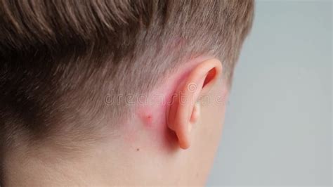 Concept Of Allergic Reaction By Mosquito Bites Ear Close Up Stock Footage Video Of